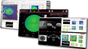 HEIDELBERG EYE EXPLORER - Oculamed Medical Electronics