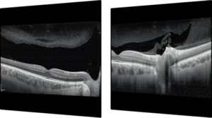 SPECTRALIS® HRA+OCT - Oculamed Medical Electronics